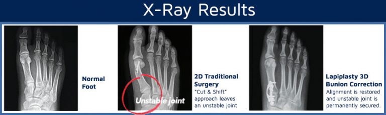 Lapiplasty 3D Bunion Correction | NASA MRI